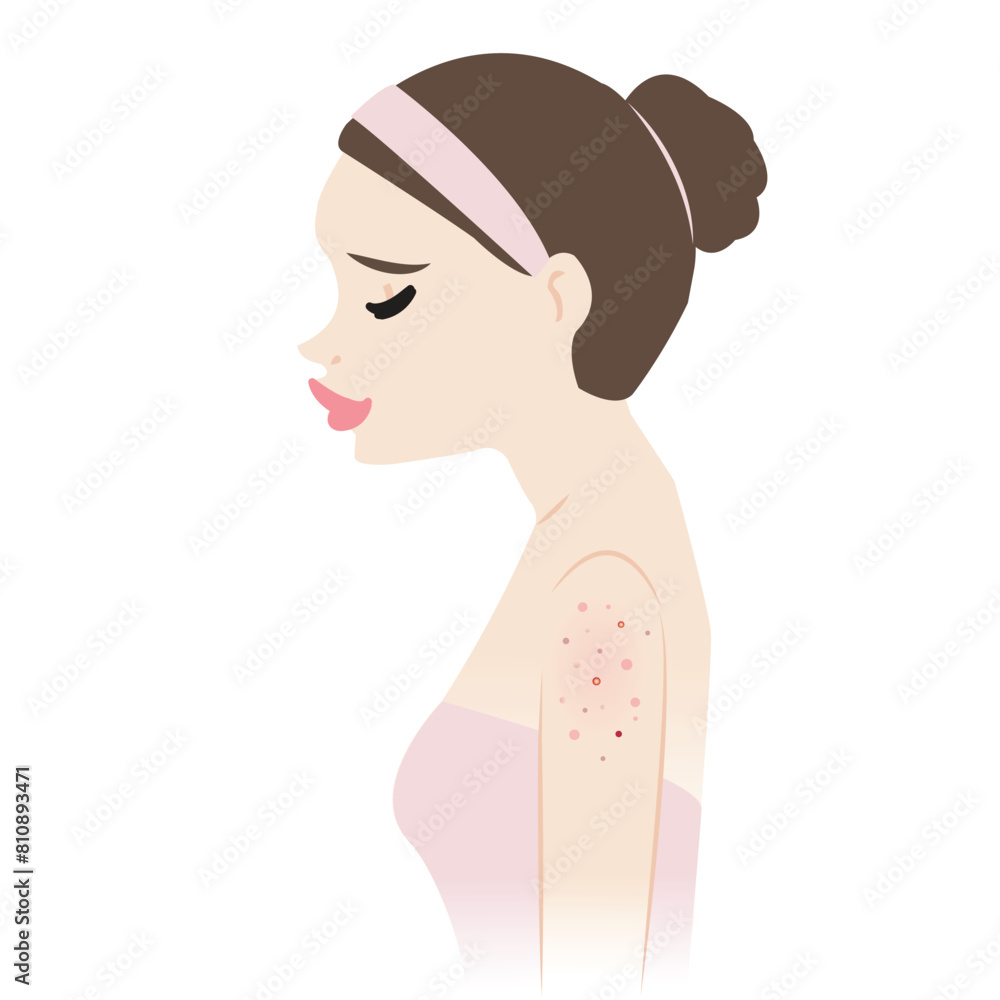The woman with acne on upper arms vector illustration isolated on white ...