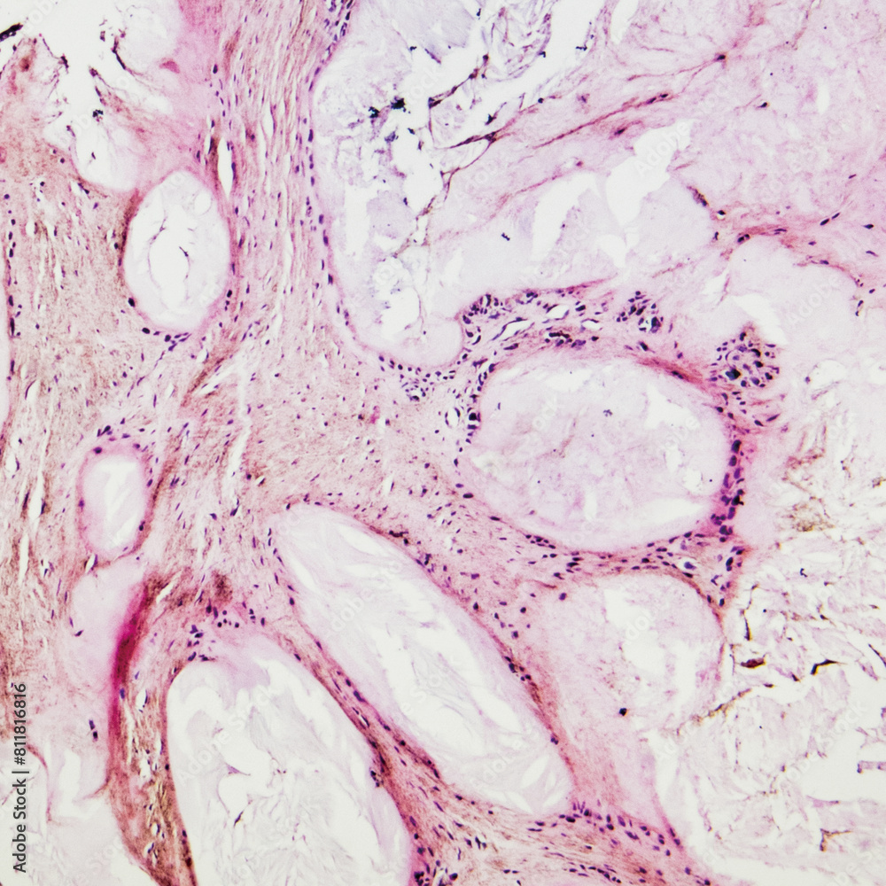 This is a pathological photo of a human gout nodule, showing the ...