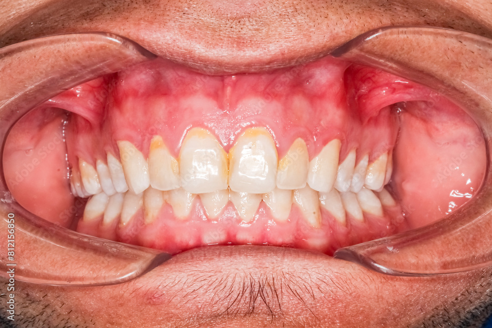 Fotografia Frontal view of dental maxillary and mandibular arches in ...