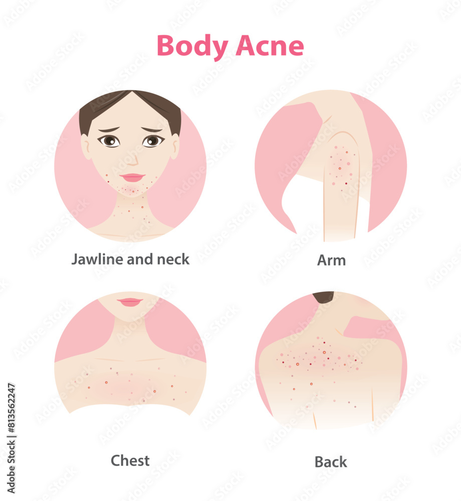 Acne on face and body woman vector icon set on white background ...