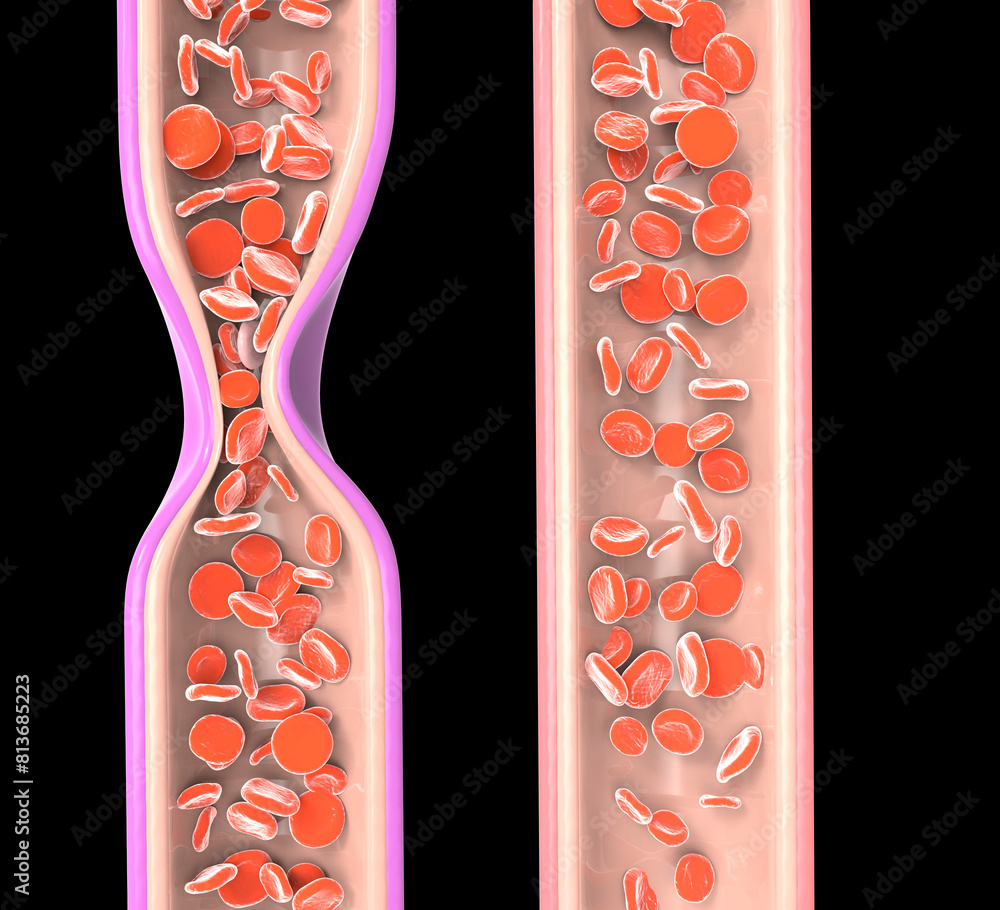 Obstructed vein due to thrombosis and normal vein with blood cells ...