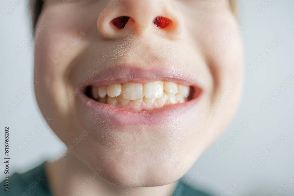 child 12 years old shows tooth sways and hurts, concept pediatric ...