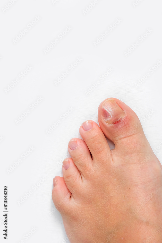 Pedicure, podologist. Patient on medical pedicure procedure, nail ...