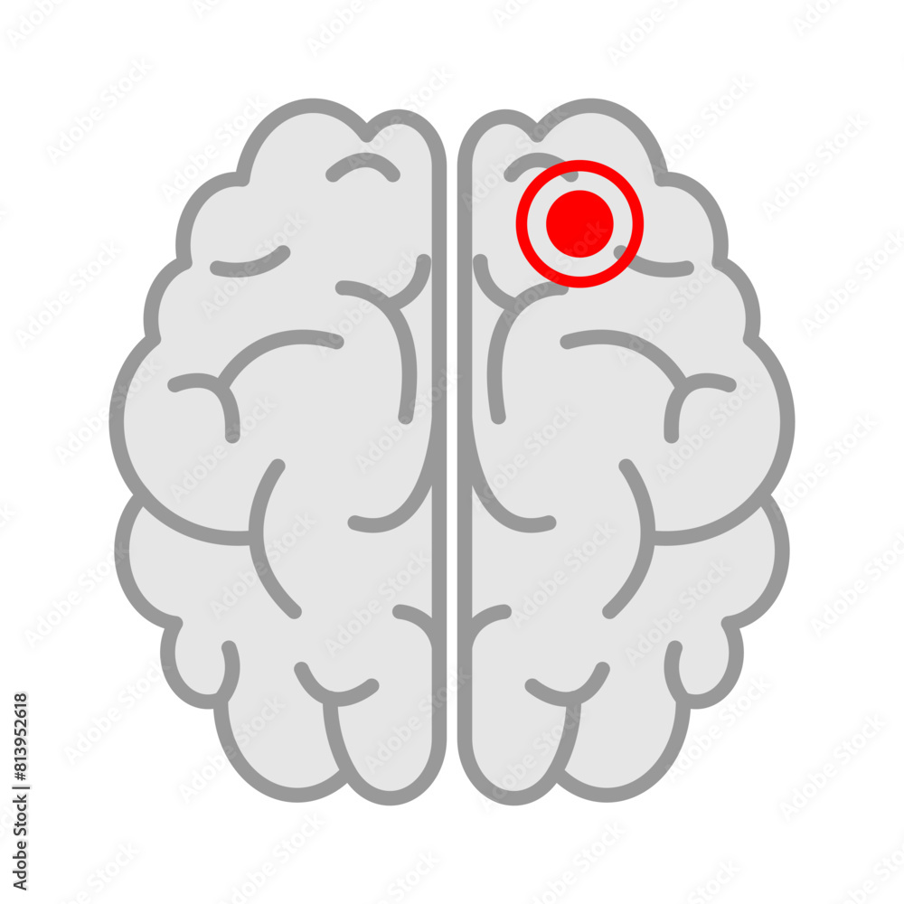 Vector illustration of brain tumor on transparent background Stock ...