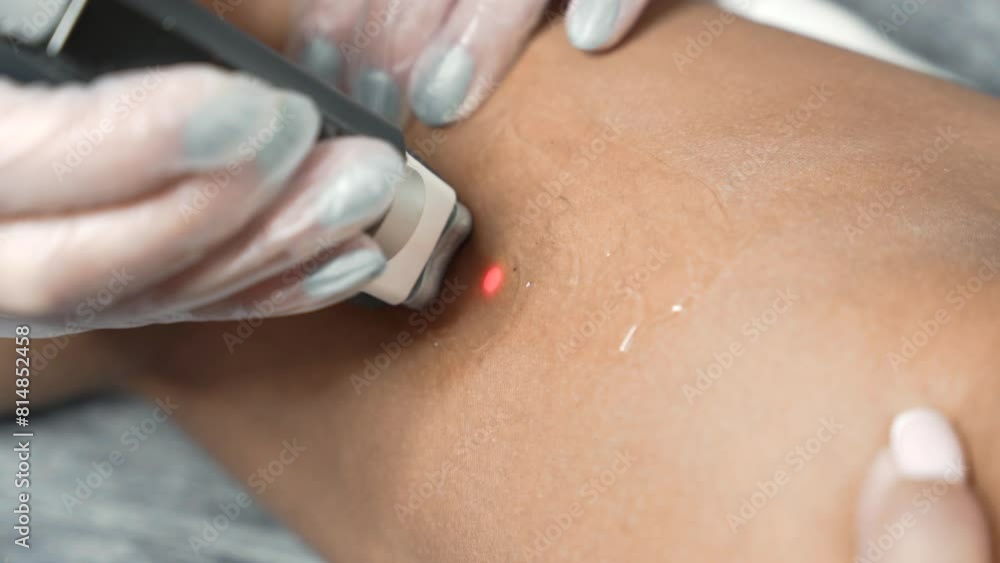 Close-up shot of Removal of blood vessels with a laser. Removal of red ...