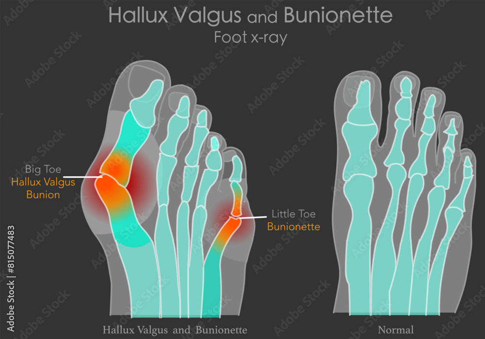 X-ray, roentgen sample. Top foot x ray big toe symptom structure ...