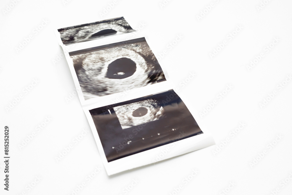 Ultrasound Picture Of 6 Weeks Fetus of Pregnant Woman, Embryo Image On ...