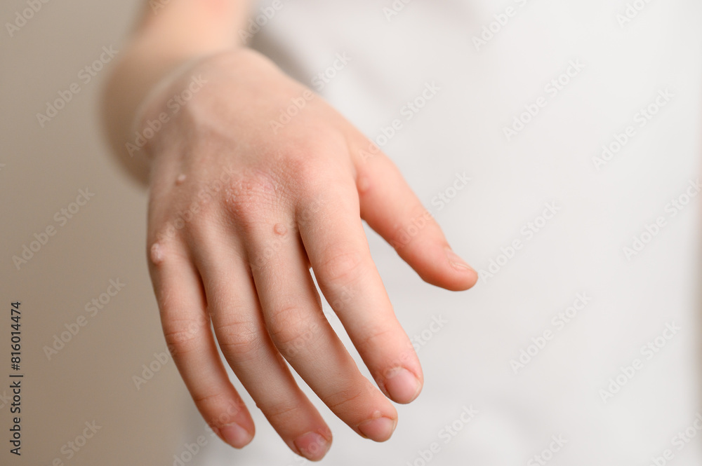 Many warts on child hand, flat wart, close-up, Verruca vulgaris. Human ...