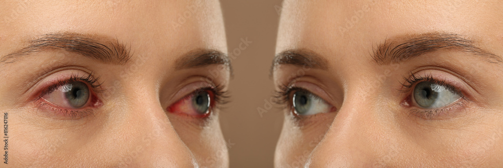 Before and after conjunctivitis treatment. Photos of woman with red and ...