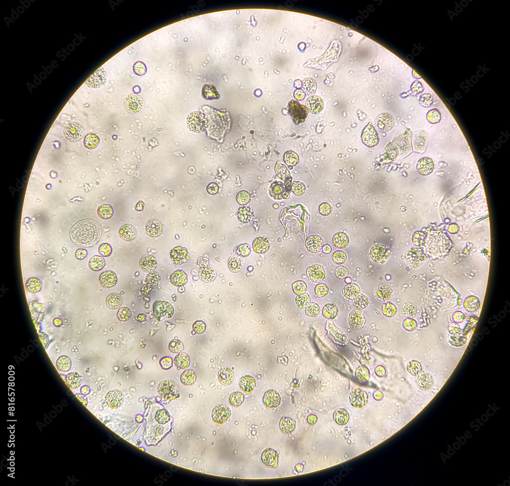 Pus cells (WBC), Red blood cells (RBC) and occasionally epithelial ...
