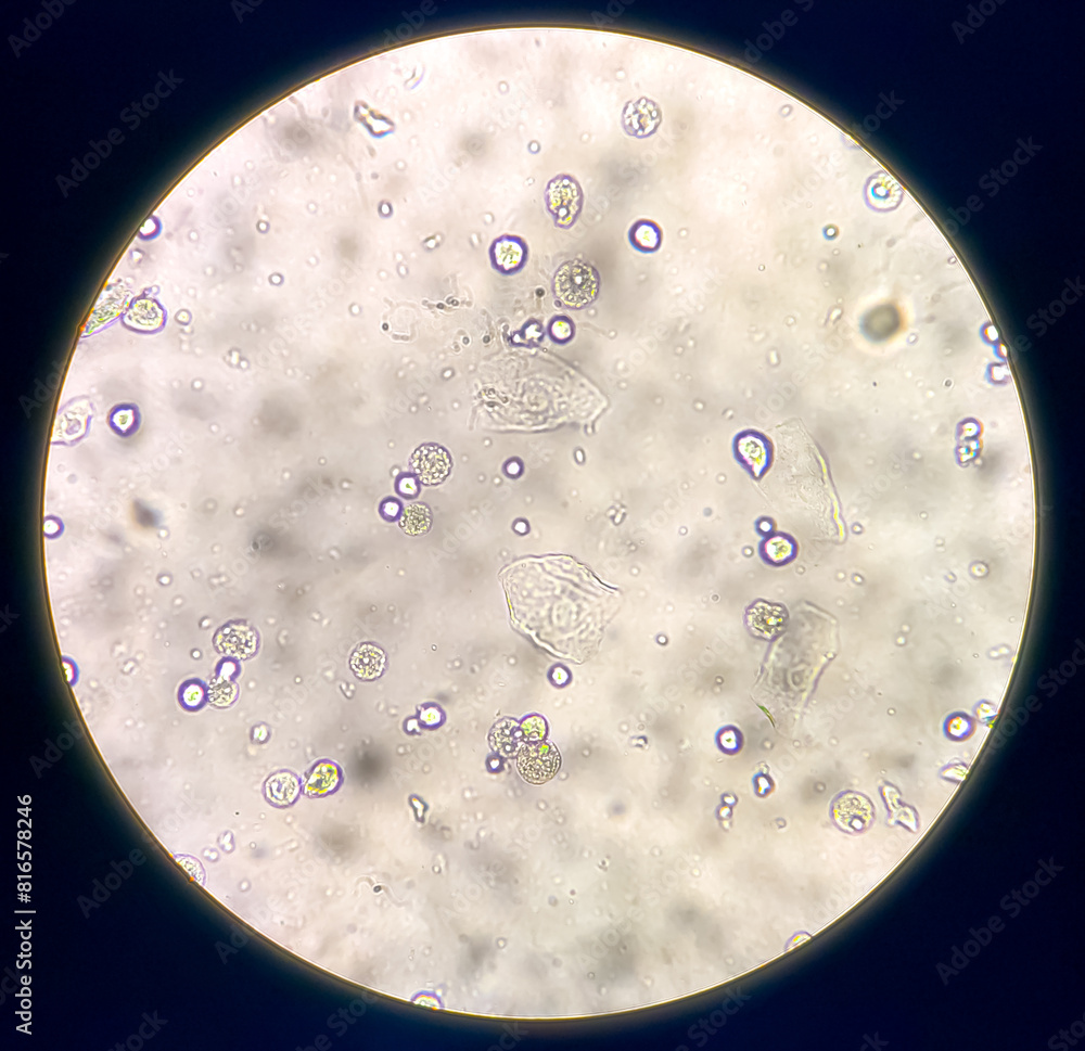 Pus cells (WBC), Red blood cells (RBC) and occasionally epithelial ...