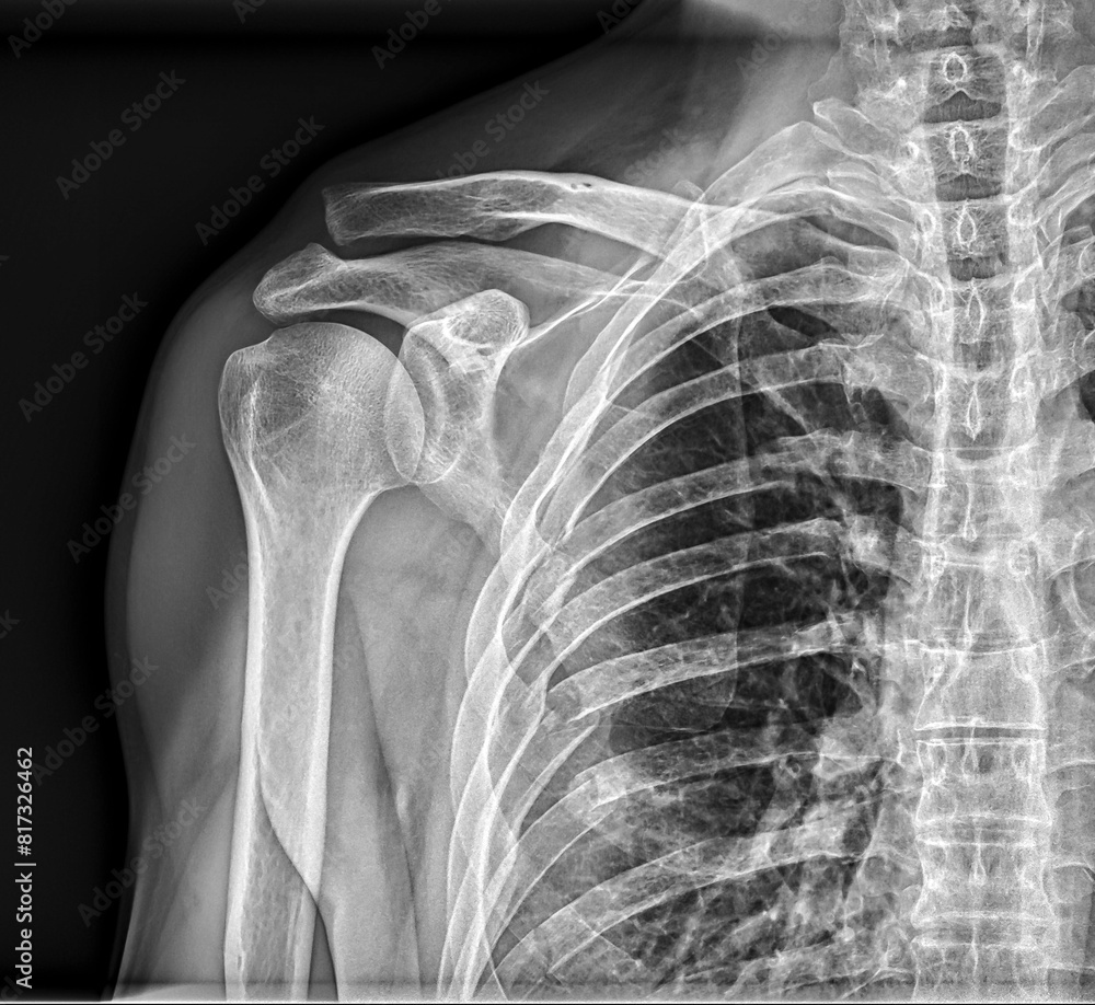 X ray radiograph right shoulder with many broken ribs and shoulder ...