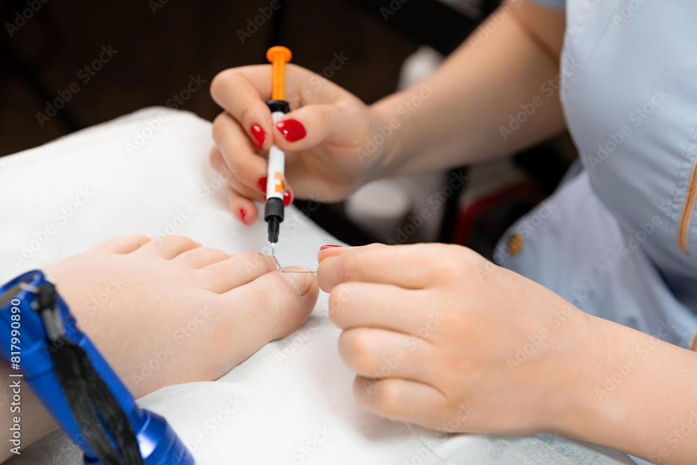 Titanium thread or metal corrective brace on the nail of the big toe ...