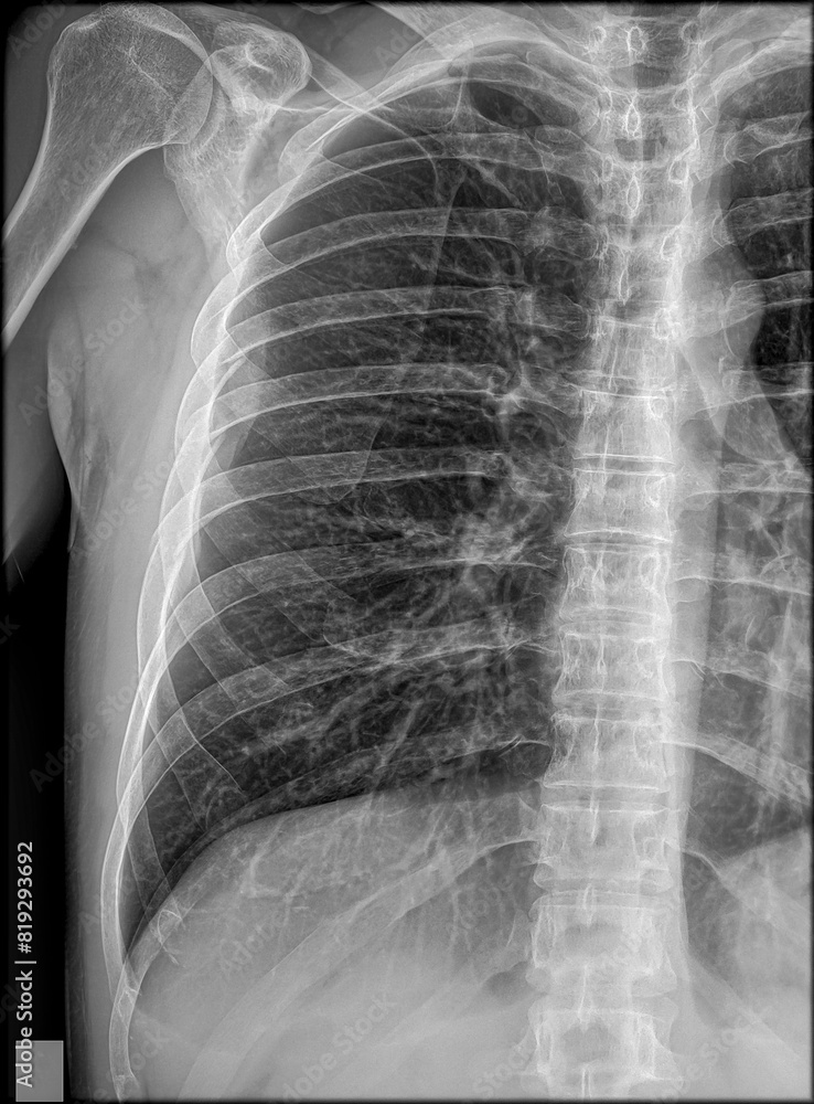 Chest radiograph with broken rib cage and shoulder dislocation injury ...