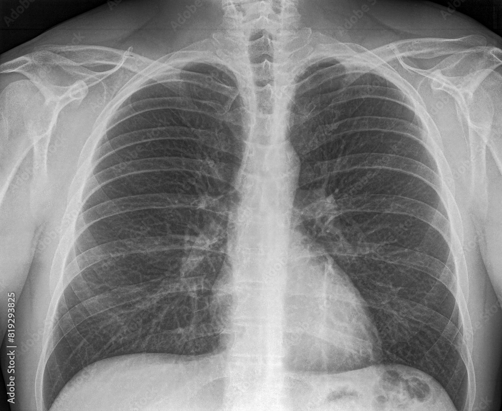 Chest radiograph with broken rib cage and shoulder dislocation injury ...