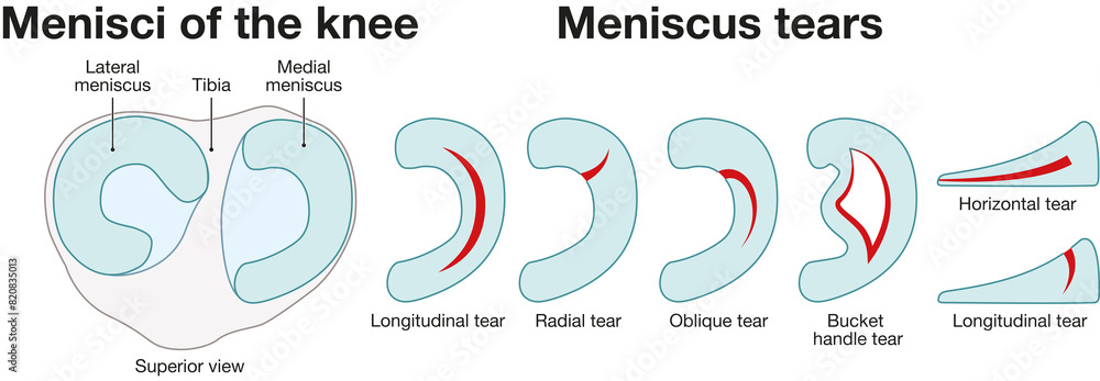 Meniscus tears of the knee joint. Anatomy, injury. Labeled Illustration ...