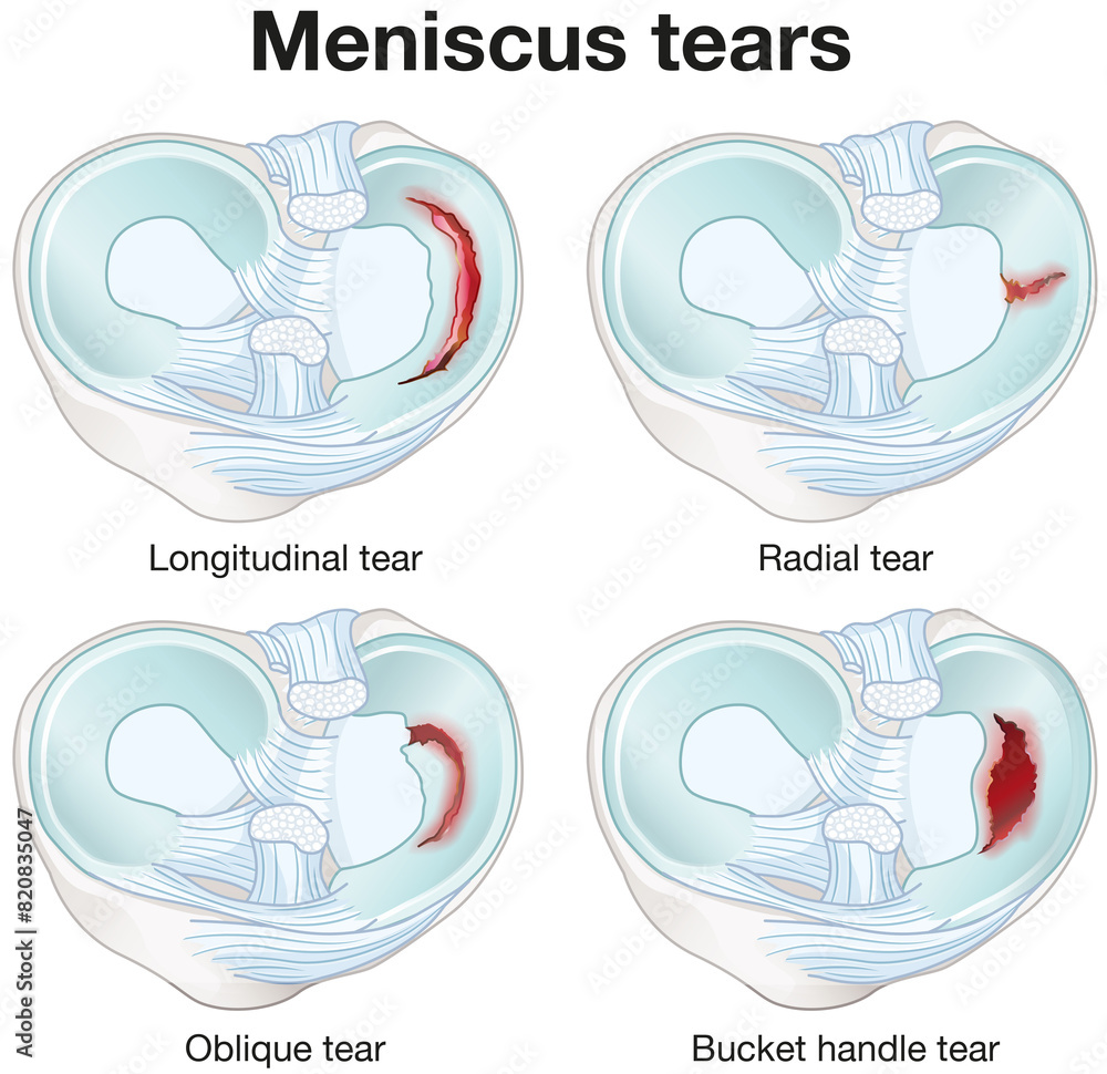 Meniscus tears. Anatomy, injury. Labeled Illustration Stock ...