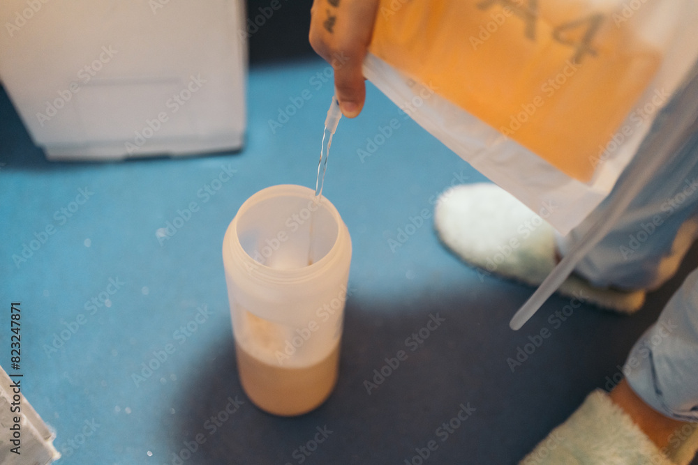 Hands holding a urinary catheter bag, filling a plastic sample ...