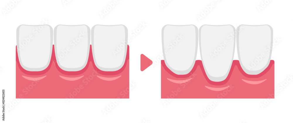 Vector illustration of healthy gums and gingival recession Stock Vector ...