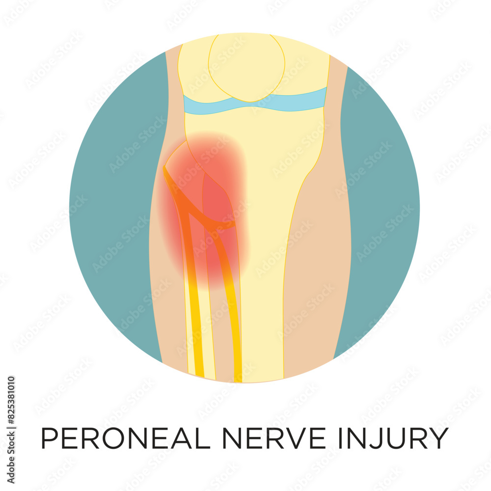 Peroneal nerve flat style vector illustration in circle layout with ...
