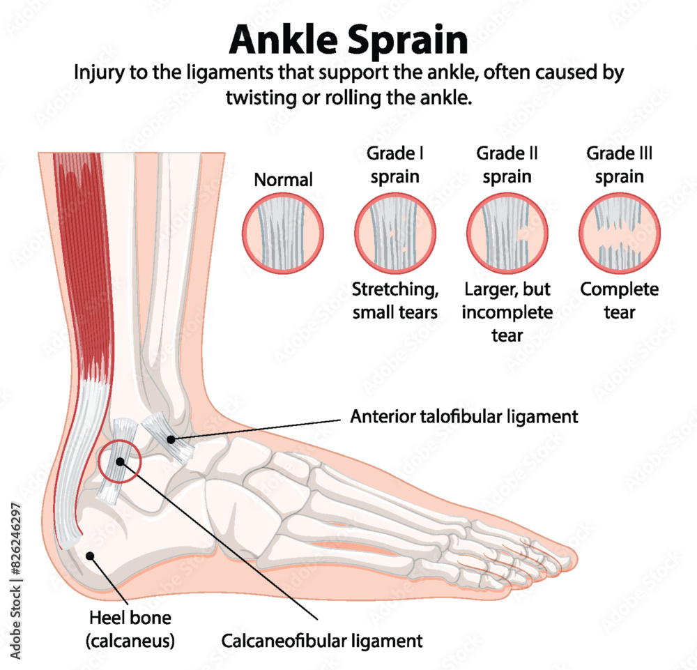 Detailed diagram of ankle sprain types Stock Vector | Adobe Stock