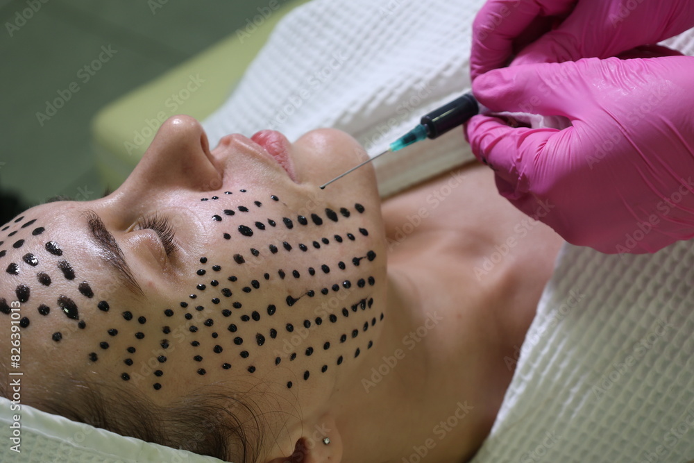 Beauty Injection. Beautiful Woman's Face With black Points On Skin ...