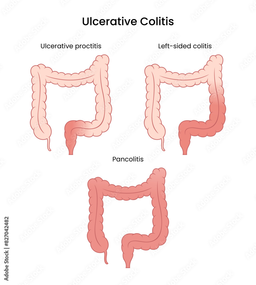 Types of Ulcerative Colitis in Humans Stock Vector | Adobe Stock