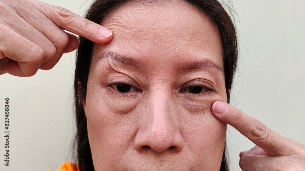 Portrait the fingers holding the flabbiness adipose sagging skin, bag eyes and flabby skin ...