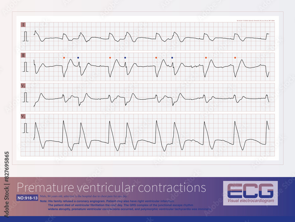 A patient with AIMI presents with a sudden widening of the QRS complex ...