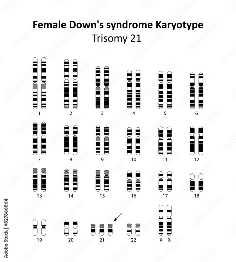 Female Down's syndrome (trisomy 21) human karyotype Stock Vector ...