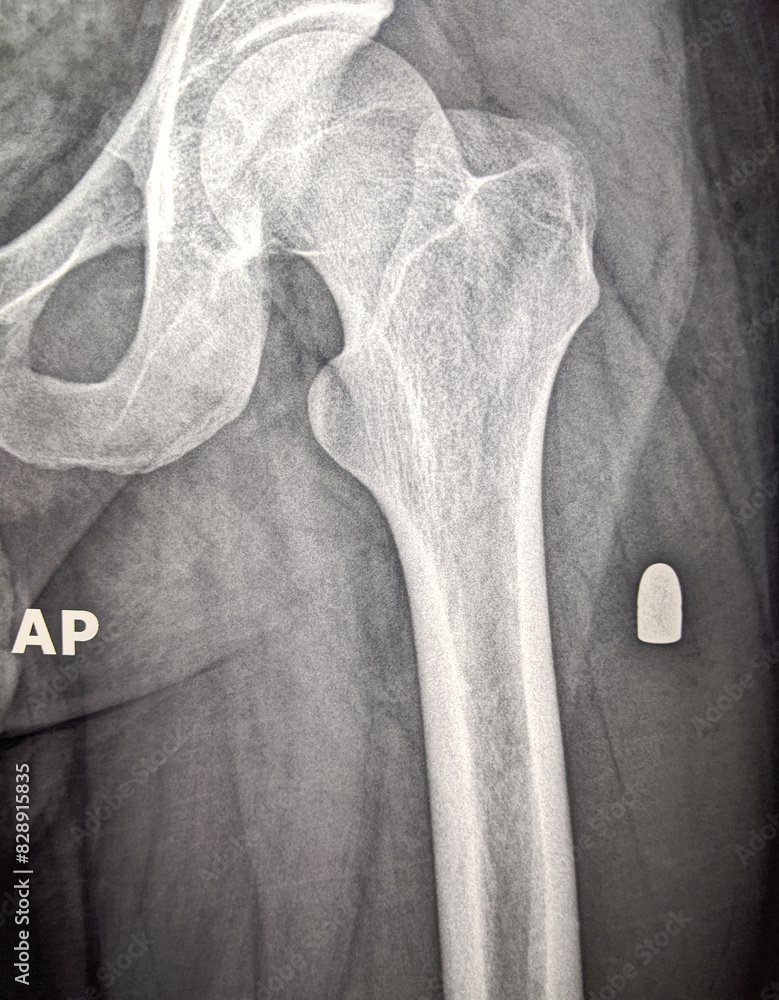 X Ray of a thigh showing a cartridge near femur Stock Photo | Adobe Stock