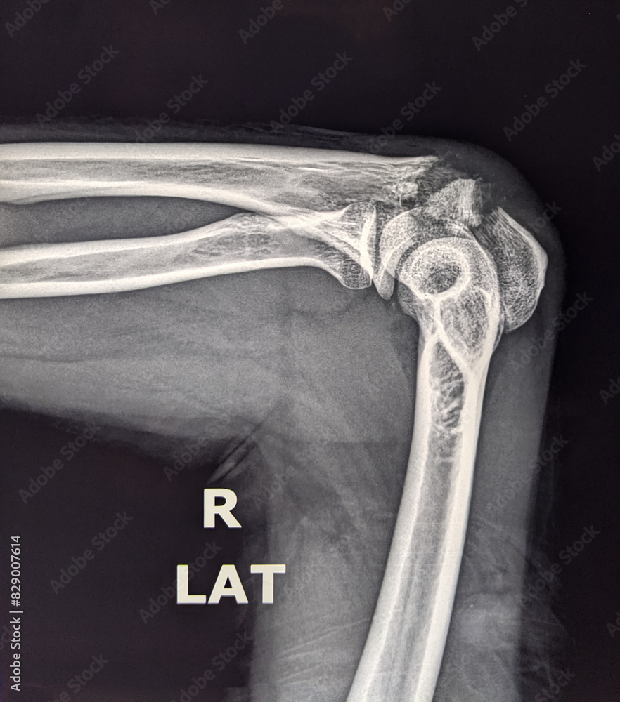 X ray of elbow joint showing olecranon fracture Stock Photo | Adobe Stock