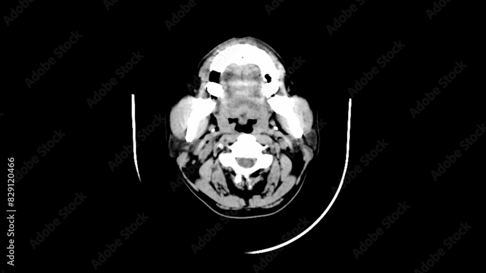 normal head ct scan brain window Stock Illustration | Adobe Stock
