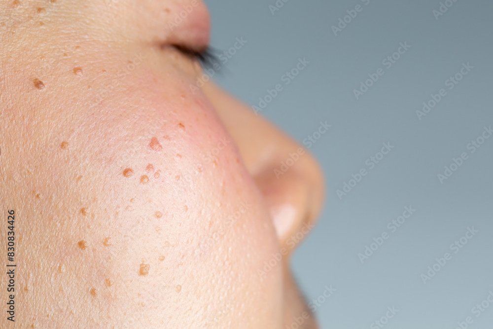 Seborrheic keratosis, pore, acne and wrinkles in face woman skin macro ...