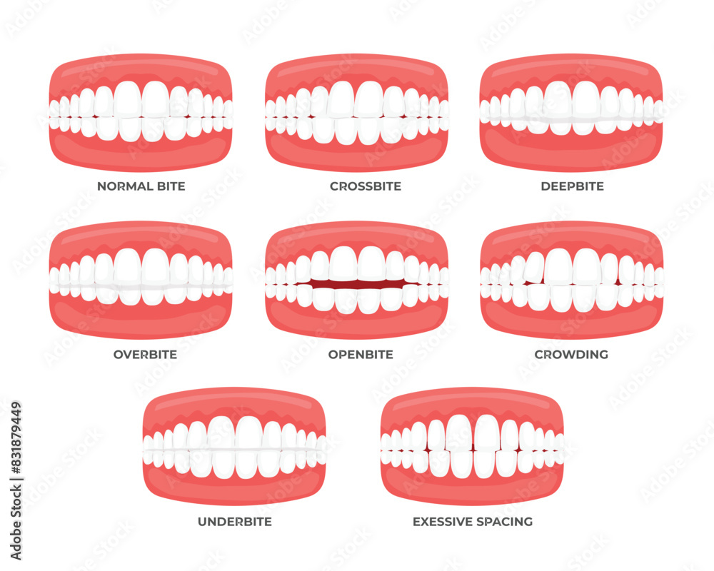 Set of Malocclusion types set with side view of normal, misalignment ...