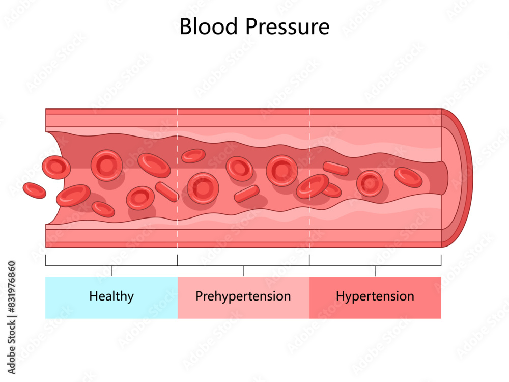 blood pressure levels, showing healthy, prehypertension and ...