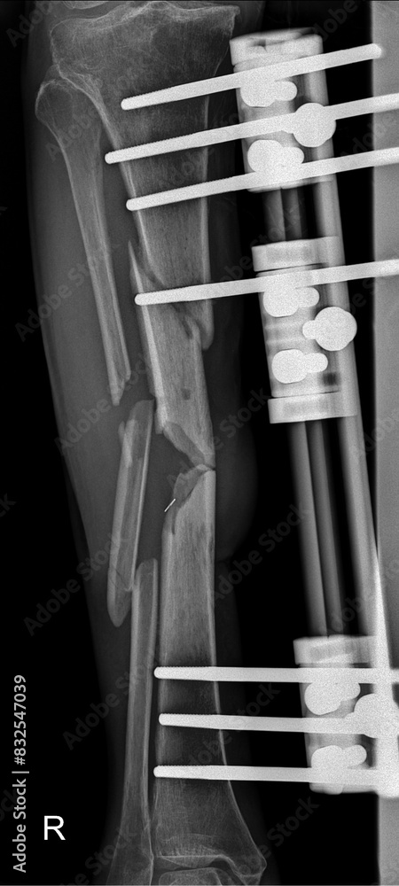 Tibia fibula fracture external fixation radiograph Stock Photo | Adobe ...