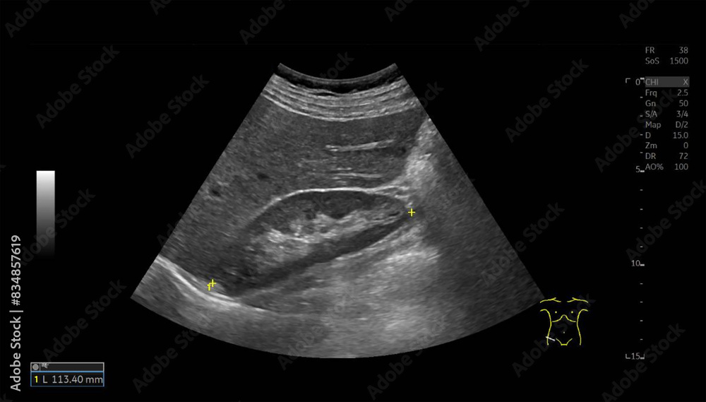 Kidney Ultrasound Images with Detailed Renal Structures, Perfect for ...