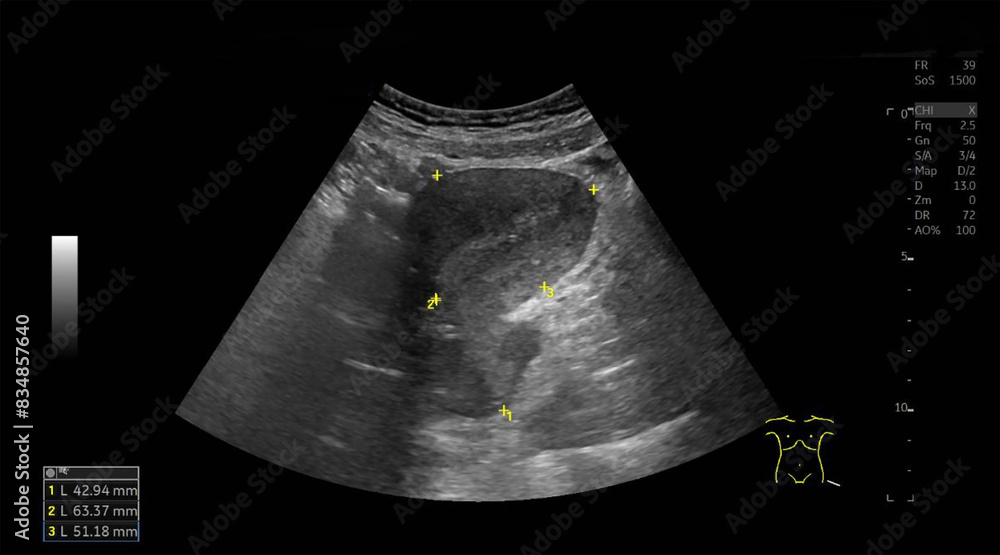 Kidney Ultrasound Images with Detailed Renal Structures, Perfect for ...