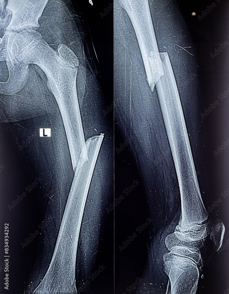 X ray image showing shaft of Femur fracture Stock Photo | Adobe Stock