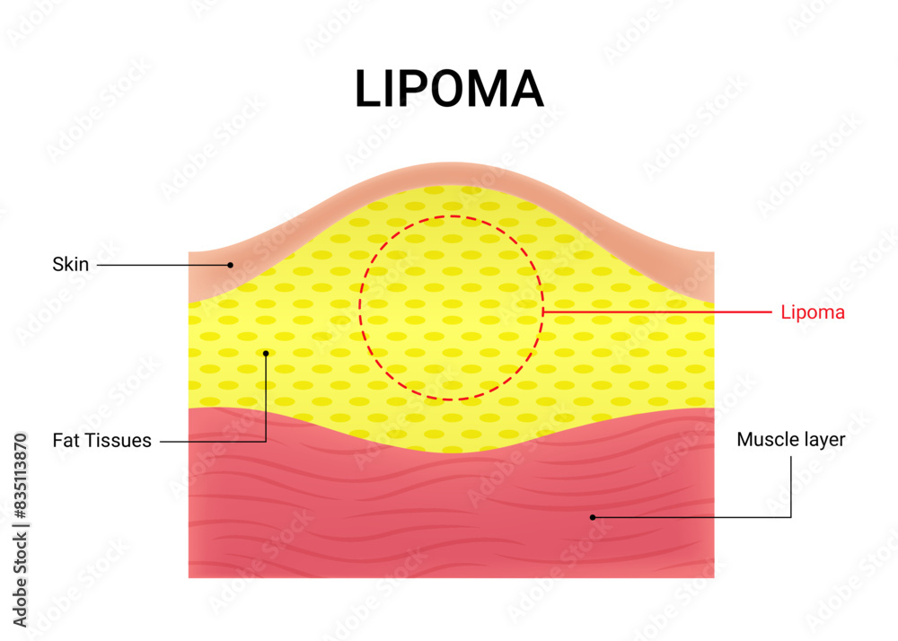 Lipoma illustration human skin cross section Stock Vector | Adobe Stock