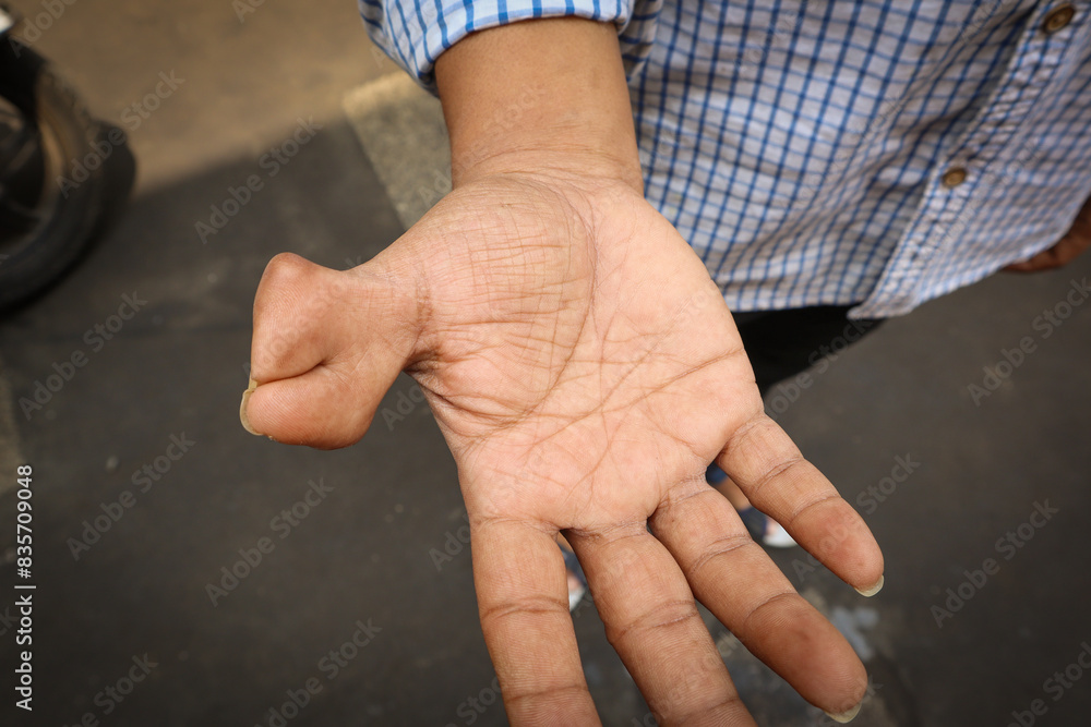 A Close up picture of an abnormal human hand known as Congenital hand ...