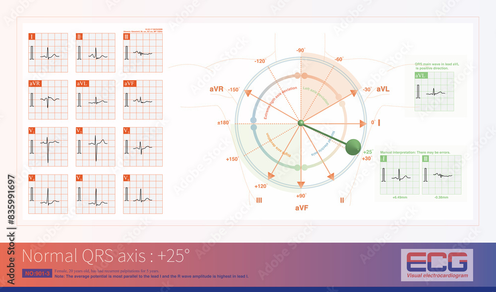 When the frontal QRS axis is at +25°, the average potential is most ...