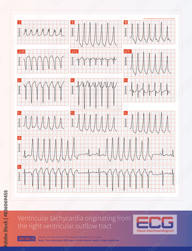 Poster Ventricular tachycardia originating from the right ventricular ...