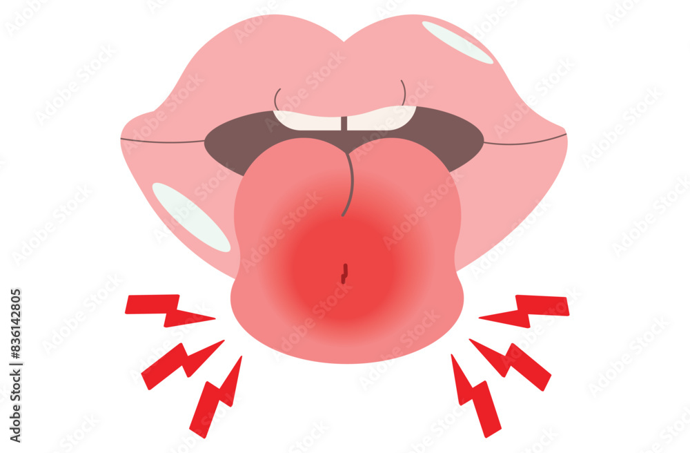 Vetor de Angioedema is a rapid swelling of the deeper layers of the ...