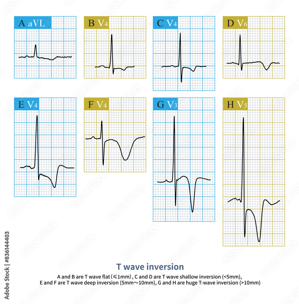 T wave inversion is a common ECG phenomenon, which can be a normal ECG ...