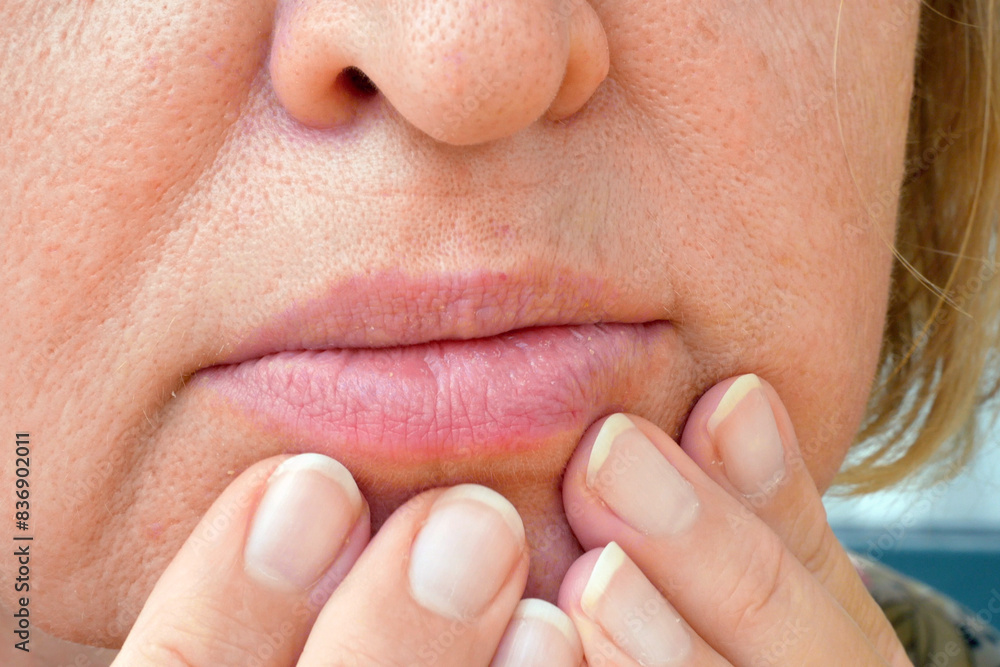 stomatitis in mouth closeup, lip with aphthous stomatitis, treatment of ...