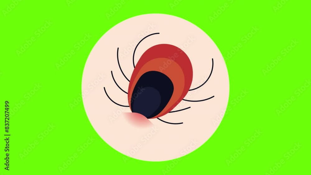 Illustrative animation of tick bite. Tick increases in size. Cartoon ...