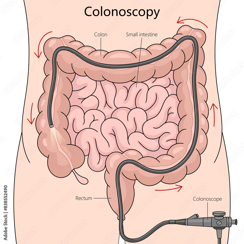 colonoscopy procedure, detailing the path of the colonoscope through the colon and small ...