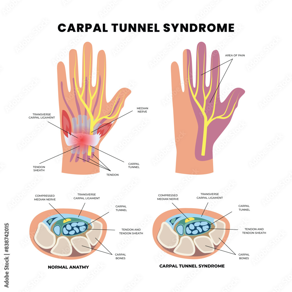 Carpal Tunnel Syndrome diagram poster infographic banner, diagram ...